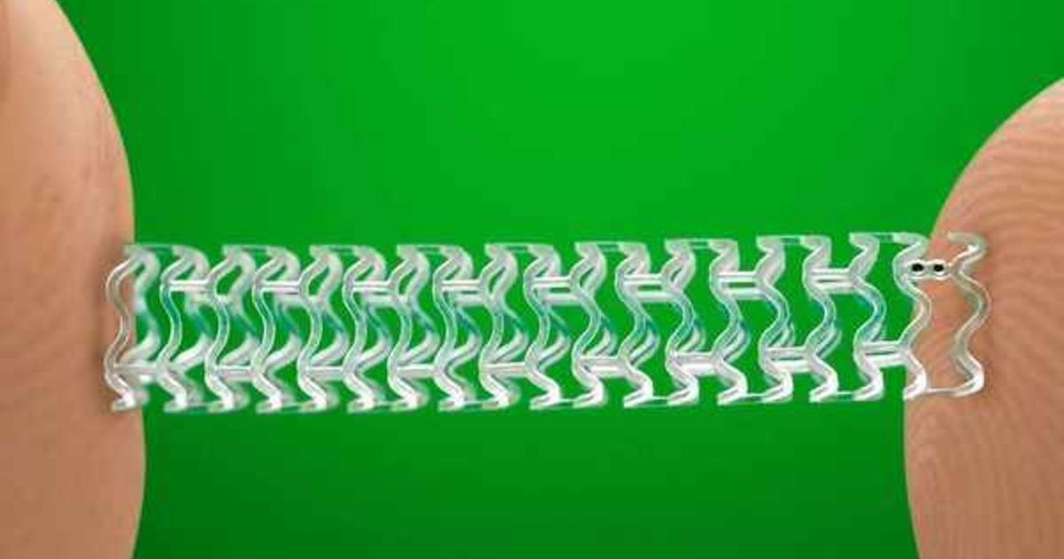 Abbott-gains-approval-for-first-fully-dissolving-artery-stent ...